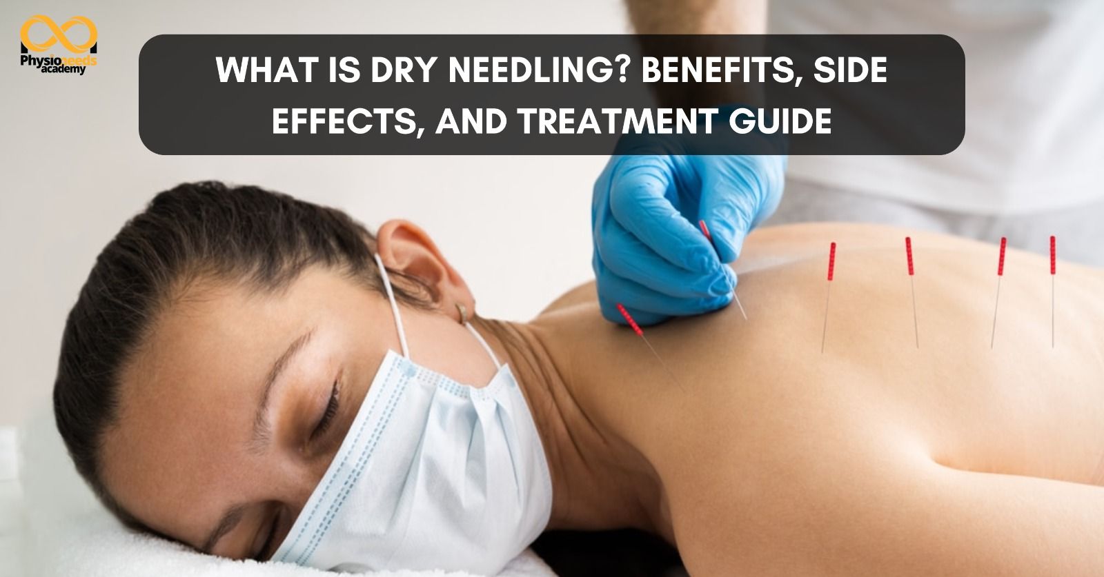 What Is Dry Needling? Benefits, Side Effects, and Treatment Guide